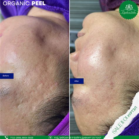 7 хоногийн өмнө ба дараа 🫰😇 Оюука Салон And Спа