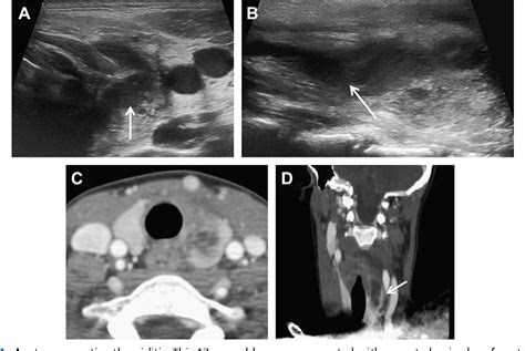Figure 26 From Thyroid Ultrasound Part 1 Technique And Diffuse Disease