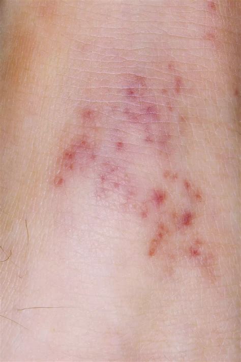 Non Blanching Rash Meaning With Fever Treatment