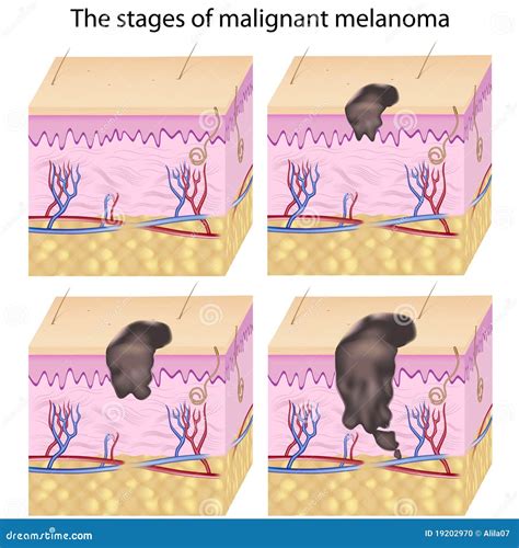 Skin Cancer Stock Vector Illustration Of Artery Anatomy 19202970