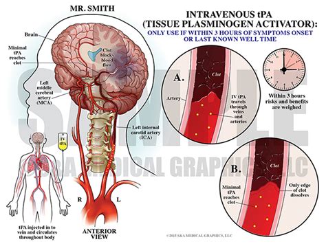 Stroke And TPA Case Study S A Medical Graphics