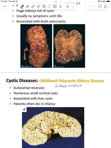 Renal Pathology Exam 5 Flashcards Quizlet