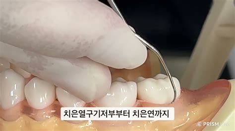 치석탐지동작 Exploring하악좌측구치부협면 치과위생사 국가 실기시험 대비 Youtube