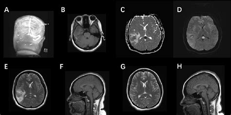 Figure 2 From Reversible Splenial Lesion Syndrome Resles Coinciding