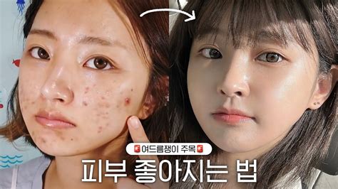 여드름 없애고 피부 좋아지는 법☀️ 피부시술 클렌징 스킨케어 습관 전부 알려드림️ 👩🏻‍🏫 Youtube