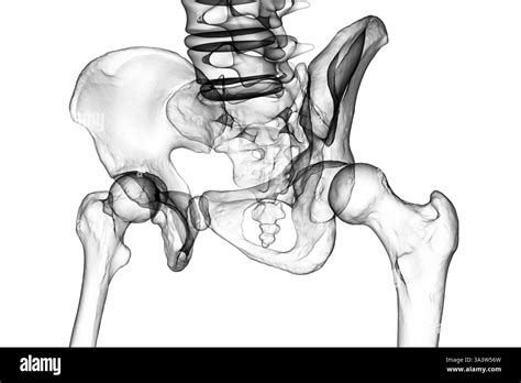 Illustration Of Hip Dysplasia Dislocation Type Showing Misalignment Of The Femoral Head And