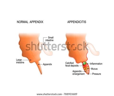 Appendicitis Healthy Inflamed Appendix Stock Vector Royalty Free