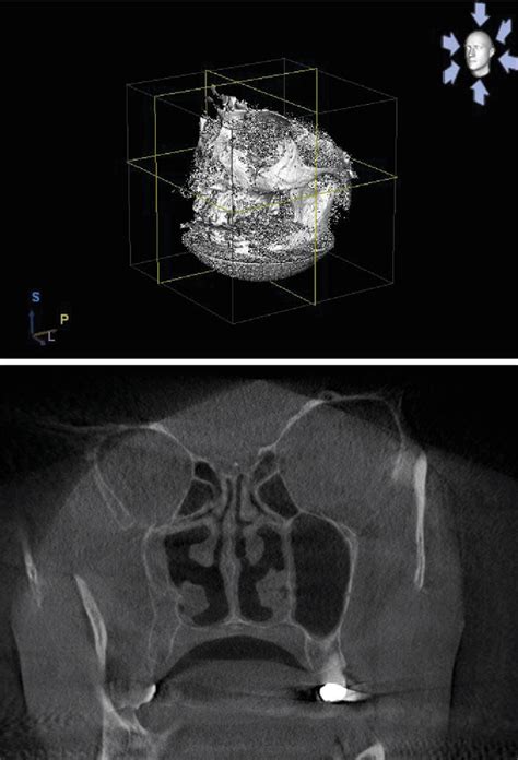 Figure 3 From The Silent Sinus Syndrome Semantic Scholar
