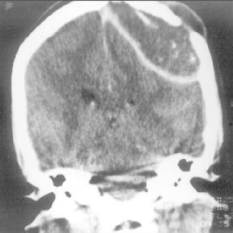 Pre Operative CT Scan Coronal Section Showing Extension Of Scalp Download Scientific Diagram