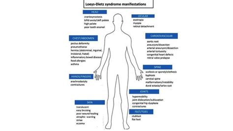 Loeys Dietz Syndrome Medlineplus Genetics