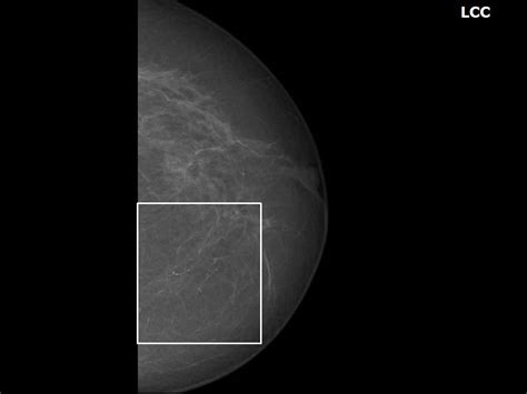 Atlas Of Breast Cancer Early Detection