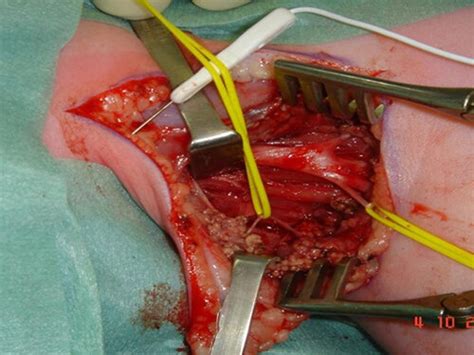 Spinal Accessory Nerve To Suprascapular Nerve Transfer San To Ssn