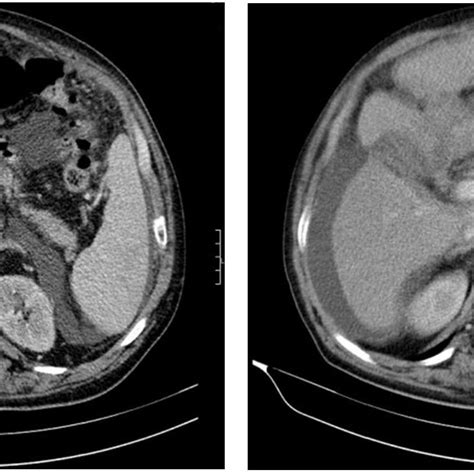 Carcinoma In The Antrum Stage Iv Extension In The Left Hepatic Lobe