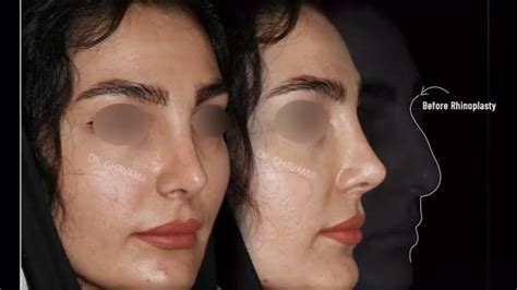 عمل بینی فانتزی با دکتر قوامی