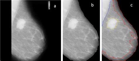Segmentation Of Image Mdb168 A Original Image B Mammography Image