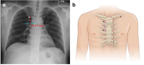 Left Subclavian Vein Central Line