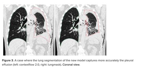 Improving Lung Segmentation For Higher Coverage Of Clinically Relevant