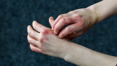 ما تريد معرفته عن التهاب الجلد التحسسي