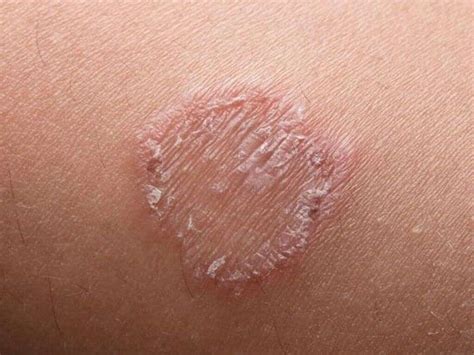 Ringworm Symptoms Causes Treatment Types Of Ringworm Tinea My Xxx Hot