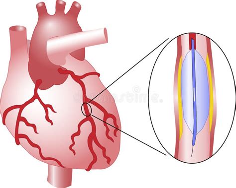 Ateroskleros Stock Illustrationer Vektorer And Clipart 2862 Stock