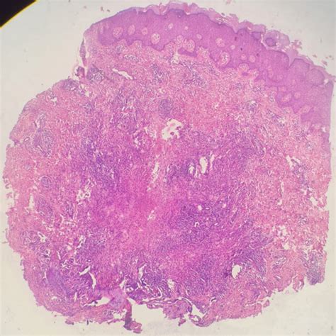 Fine Needle Aspiration Cytology Of Lymph Node Showing Granuloma