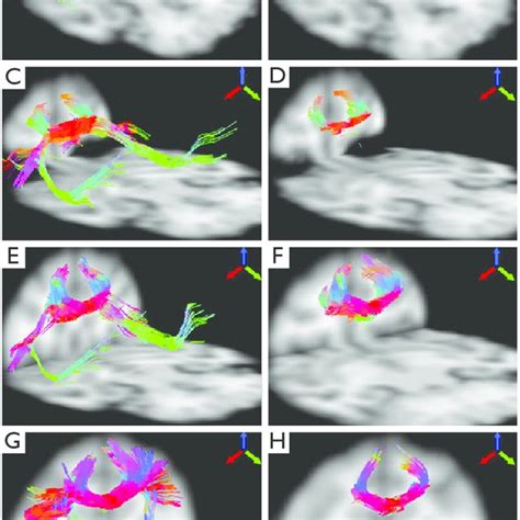 comparison of dti and dsi tractography in the white matter region with