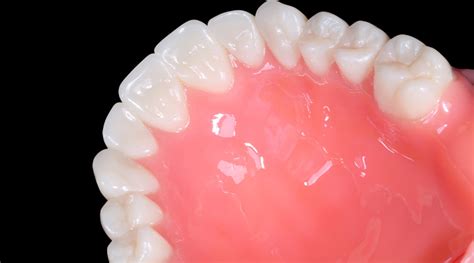 Gingiva Composites