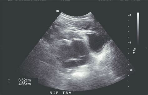 Pelvic Ultrasound Showing A Large Cyst Of The Seminal Vesicle Measuring
