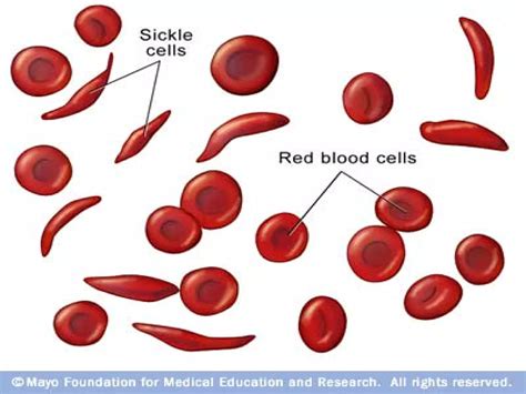 Sickle Cell Ppt
