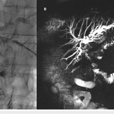 Cholangiography A And Cholangio Mri B Showing Dilatation Of Download Scientific Diagram