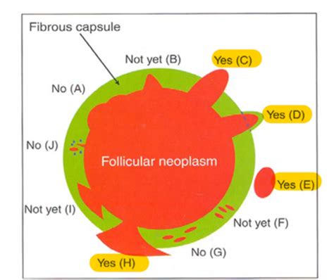 Thyroid Cap Flashcards Quizlet