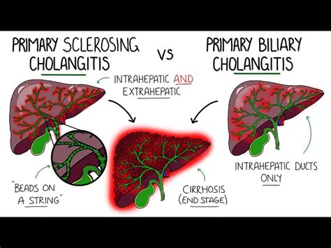 Primary Biliary Cirrhosis Vs Primary Sclerosing Cholangitis