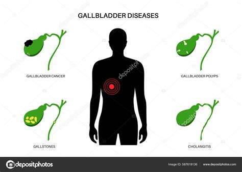 Gallbladder Diseases Infographic Gallstone Cancer Acute Cholecystitis
