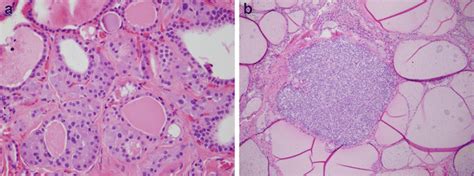 C Cell Hyperplasia With Intrafollicular Proliferation Of C Cells Download Scientific Diagram