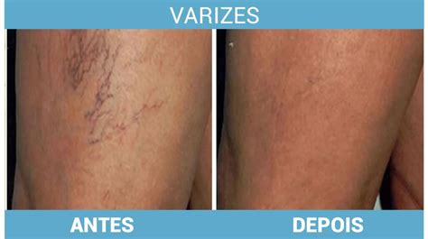 Tratamento De Varizes A Laser Veja O Antes E Depois Dos Tratamentos