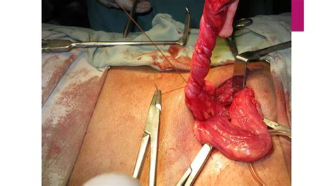 Hernia Operation Ppt