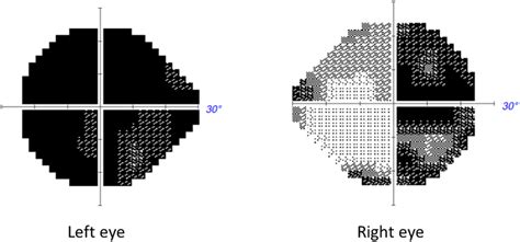 Automated Humphrey Visual Field Of Patient Described In Case 1