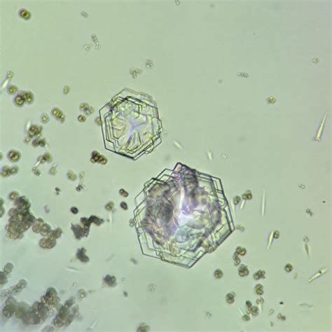 Cystine Crystals Identification And Clinical Significance