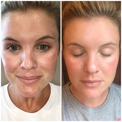Micro Needling Before And After Renew Physical Therapy