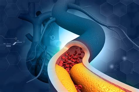 Arterial Disease Imaging In New Jerse Imagecare Centers