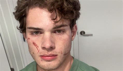 Clavicular Revelation Looksmaxxing Influencer Claims Face Descending