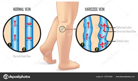 Varicosities Diagram