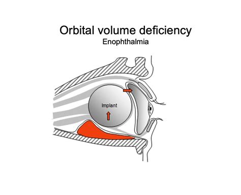 Socket Surgery For Prosthetic Eyes Nz Eye Reconstruction