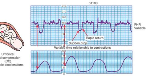 Variable Decelerations