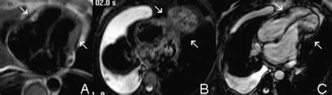 Multimodality Imaging In The Diagnosis Of Caseous Calcification Of
