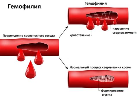 Кавитация противопоказания и побочные действия
