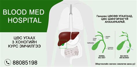 Эмнэлгийн тоног төхөөрөмж хэрэгсэл худалдаа засвар үйлчилгээ Цөс угаах 3 хоногийн курс эмчилгээ
