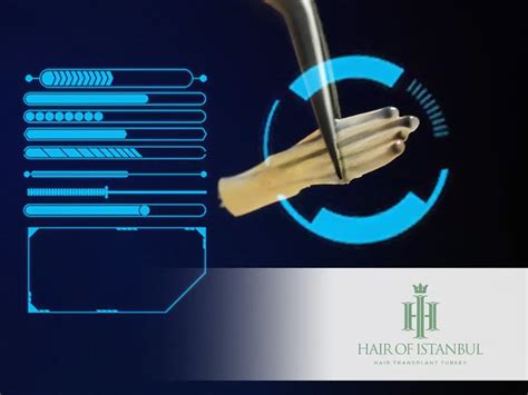 Jimmy Kimmel Hair Transplant Rumors About His Hairline