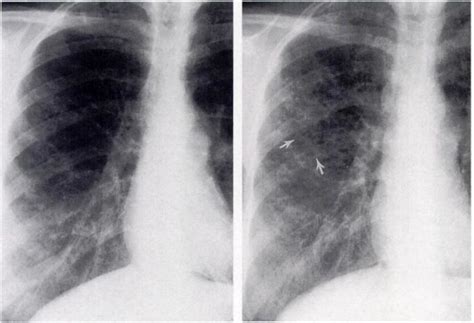 Science Direct Topics Bronchial Wall Thickening Treatment