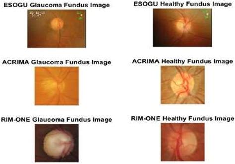 Figure 1 From Real Time Glaucoma Detection From Digital Fundus Images Using Self Onns Semantic